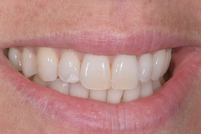 Icon Resin Infiltration - Dentique San Diego